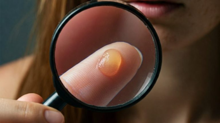 Boererate Vir Blase: Natuurlike Verligting Vir Pyn En Ongemak