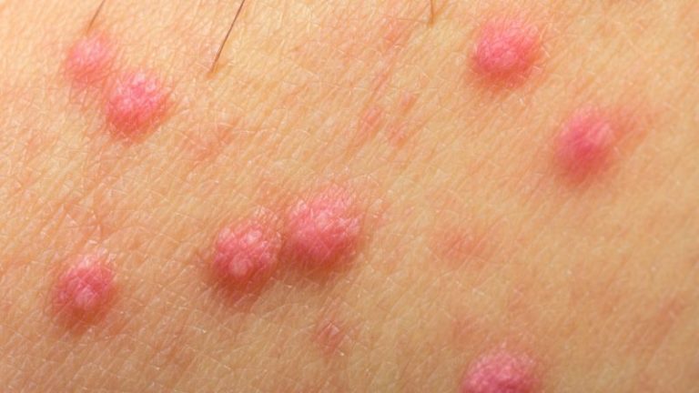 Boererate Vir Duitse Masels: Verligting En Genesing