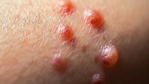 Boererate Vir Waterpokkies: Verligting Vir Jeukerige Kinders